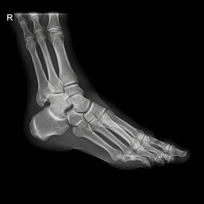 Normal Foot and Ankle X Rays: The Guide to the Foot and Ankle