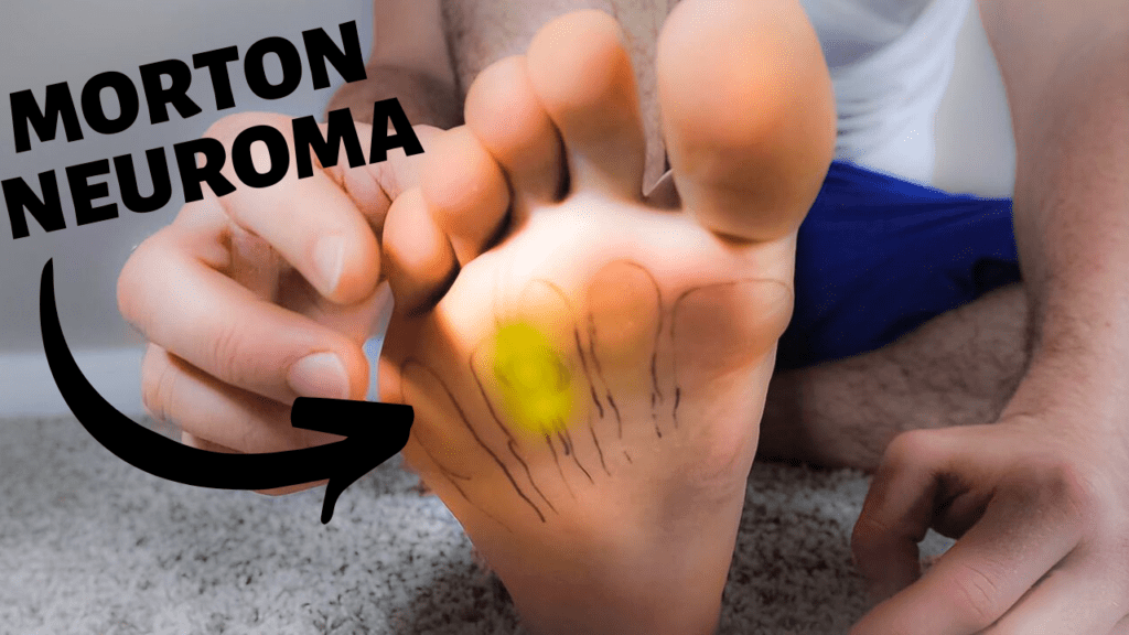 Pain in the Small Toes | Howell & Bloomfield Hills Podiatrist