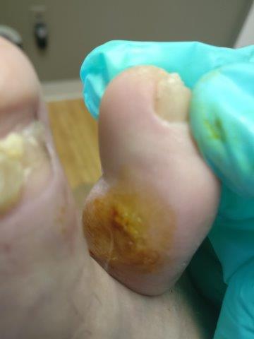 Heloma Molle: #1 Causes, Best Home Treatment & Removal