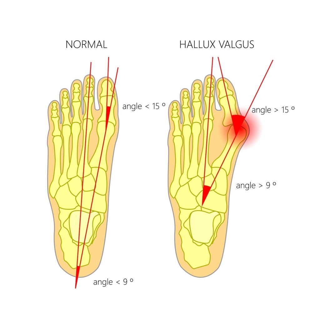 Dislocated Big Toe | 5 Causes, Symptoms & Best Treatment