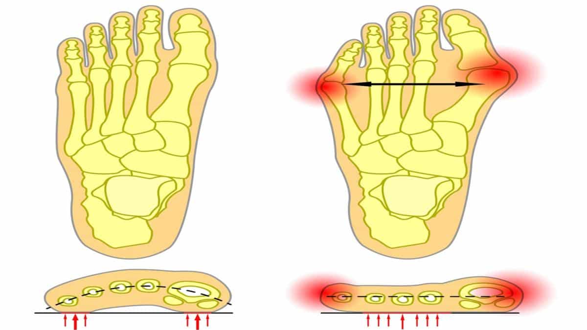 do turf toe braces work