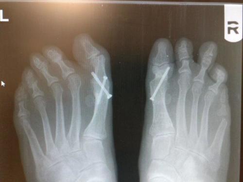 great toe joint replacement protocol