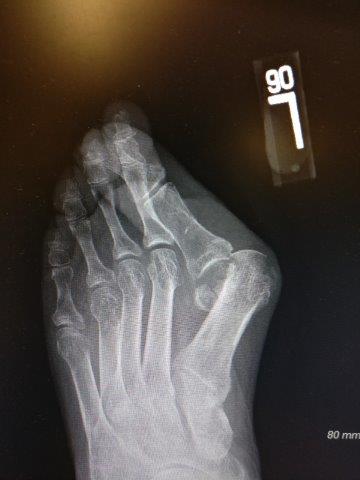 dislocated pinky toe bone