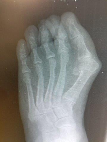 dislocated pinky toe bone